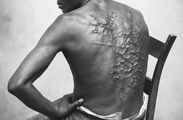 Escaped Slave Gordon Showing His Scarred Back at a Medical Examination ...